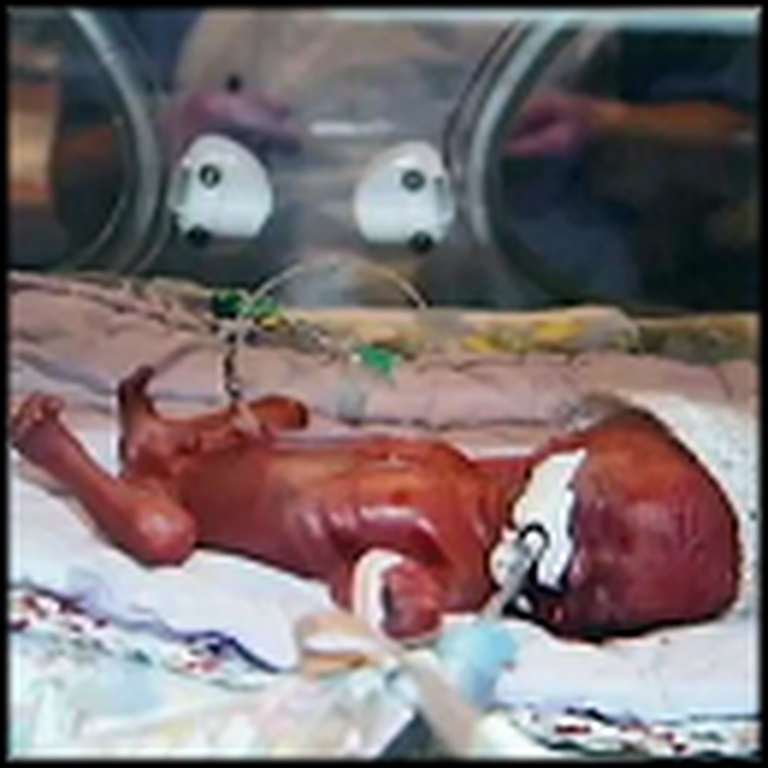 The Tiniest Little 14 Ounce Baby Becomes A Living Miracle This Video